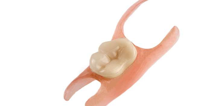 Valplast Partial Denture Single Tooth Discounted Clearance | www ... Valplast Partial Denture Single Tooth Discounted Clearance | www ...